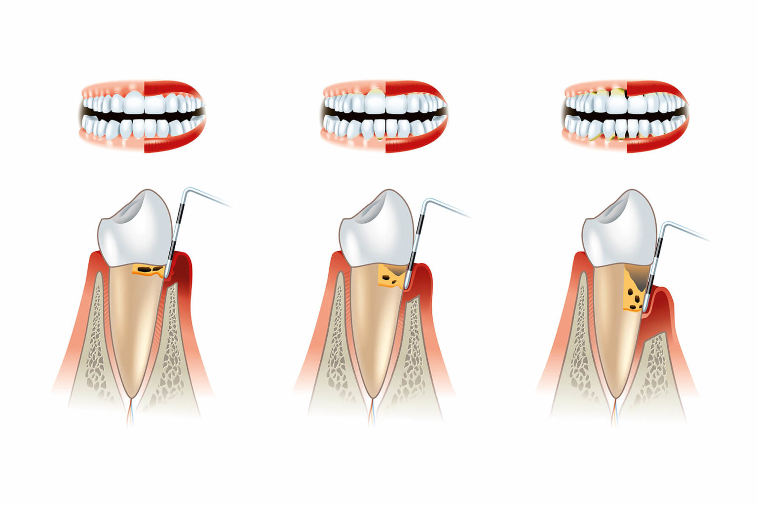 Periodontia – Moretti Odontologia